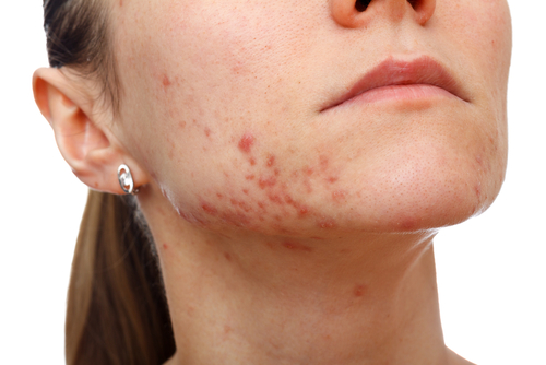 Dealing with pregnancy acne