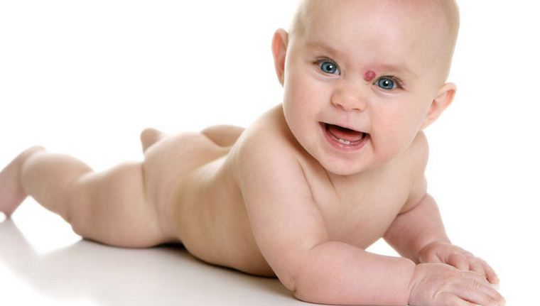 Your baby and birthmarks: what you need to know